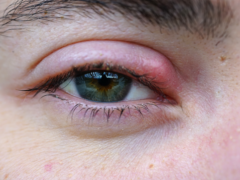 How to Get Rid of a Stye and Alleviate the Symptoms | Framesbuy
